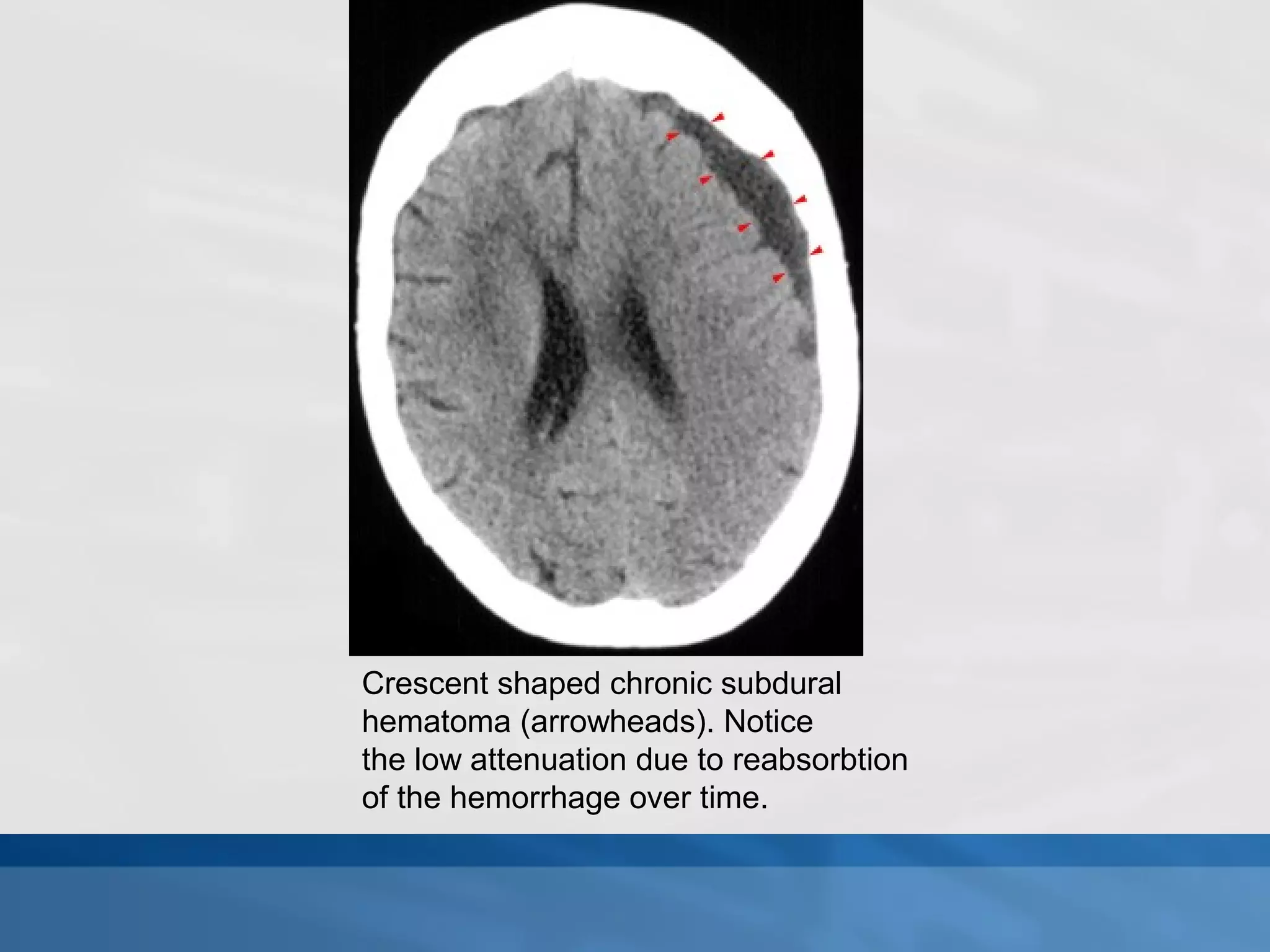 How to read a brain ct scan moderate | PPT