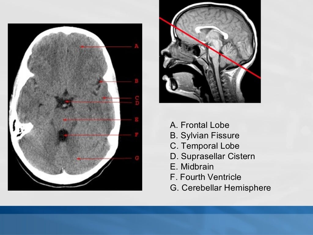 How To Read A Brain Ct Scan Moderate How To Read A Brain Ct Scan Moderate