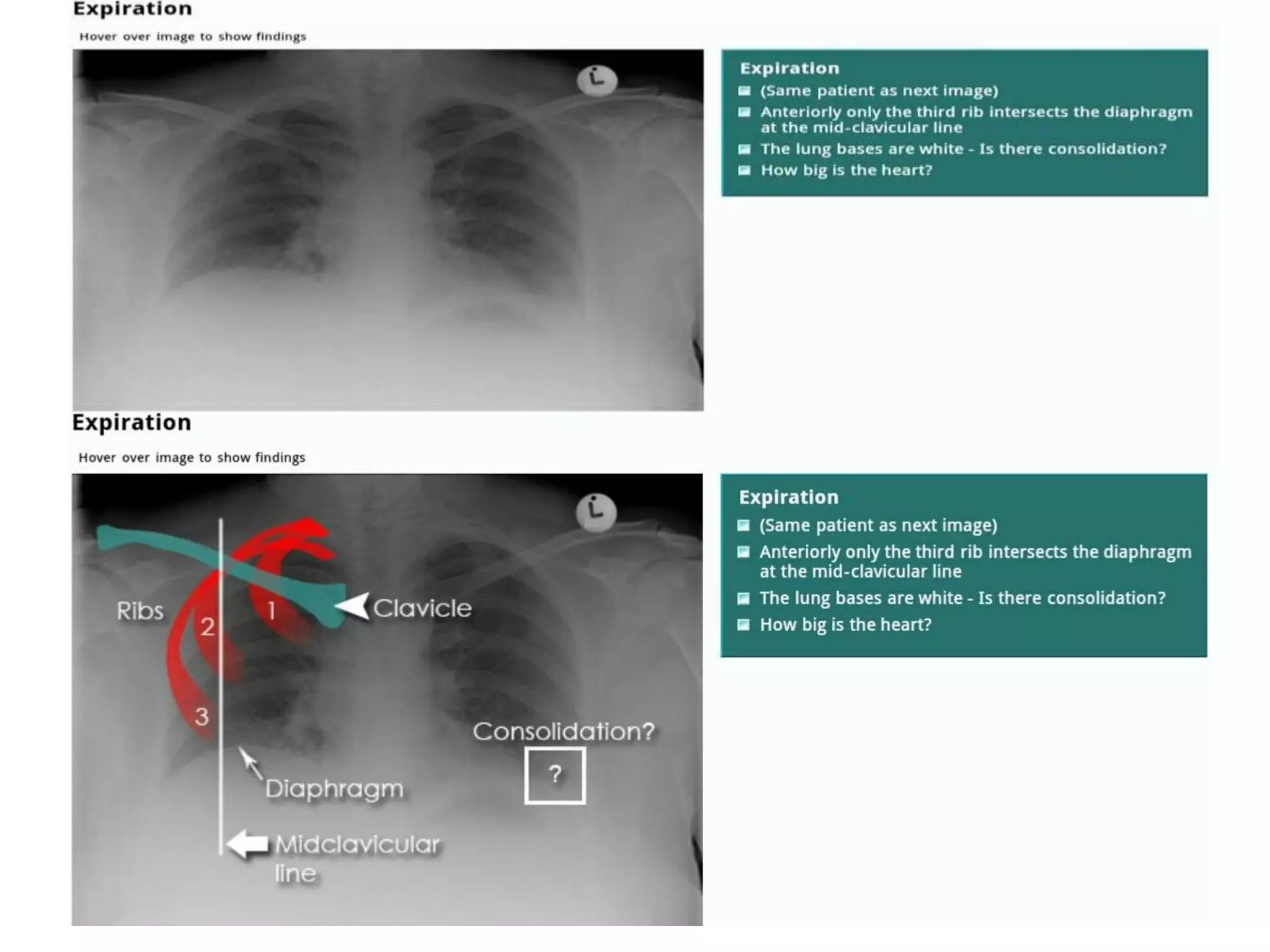 How to read a Chest X Ray film (Radiograph).pptx