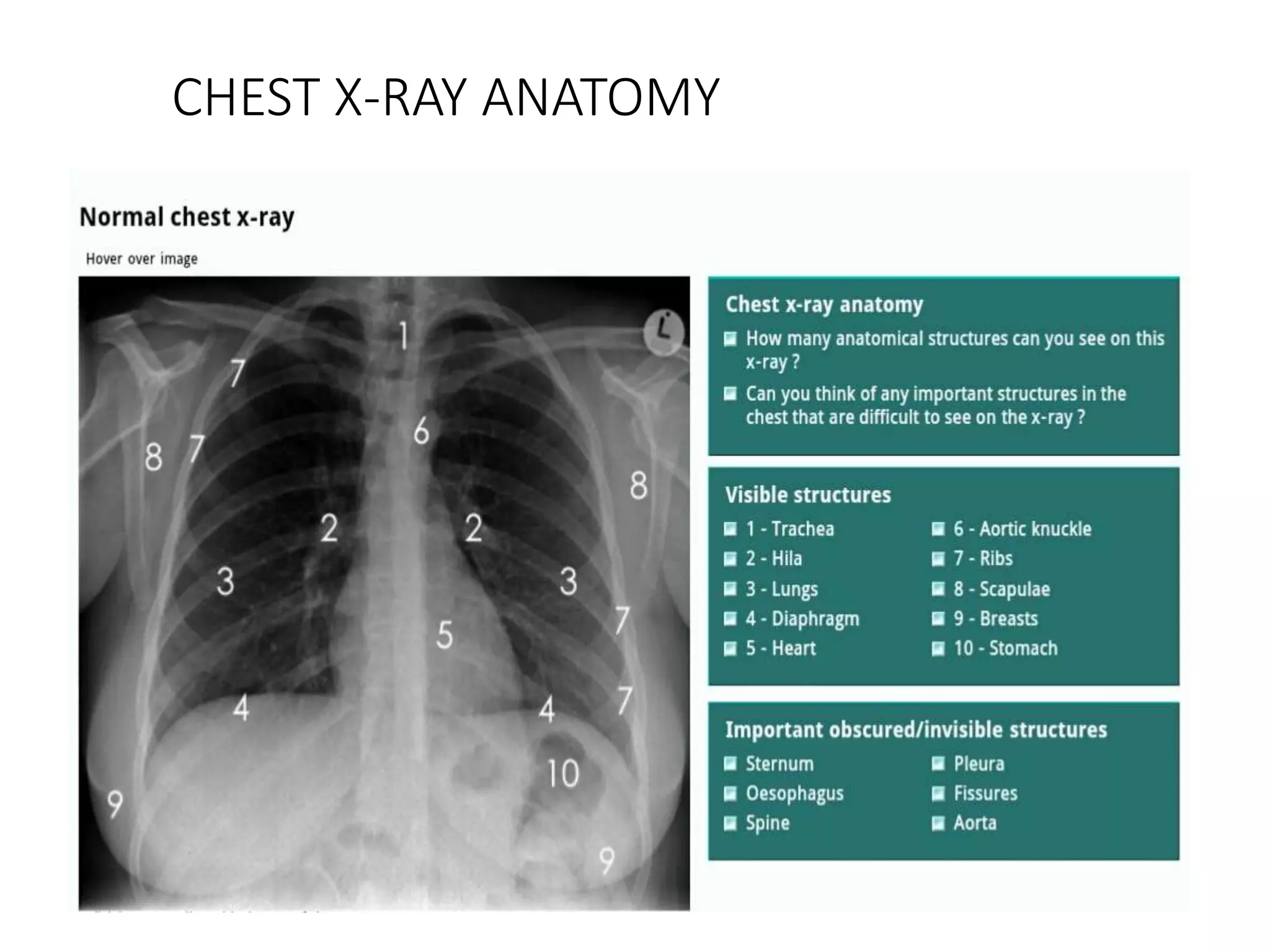 How to read a Chest X Ray film (Radiograph).pptx