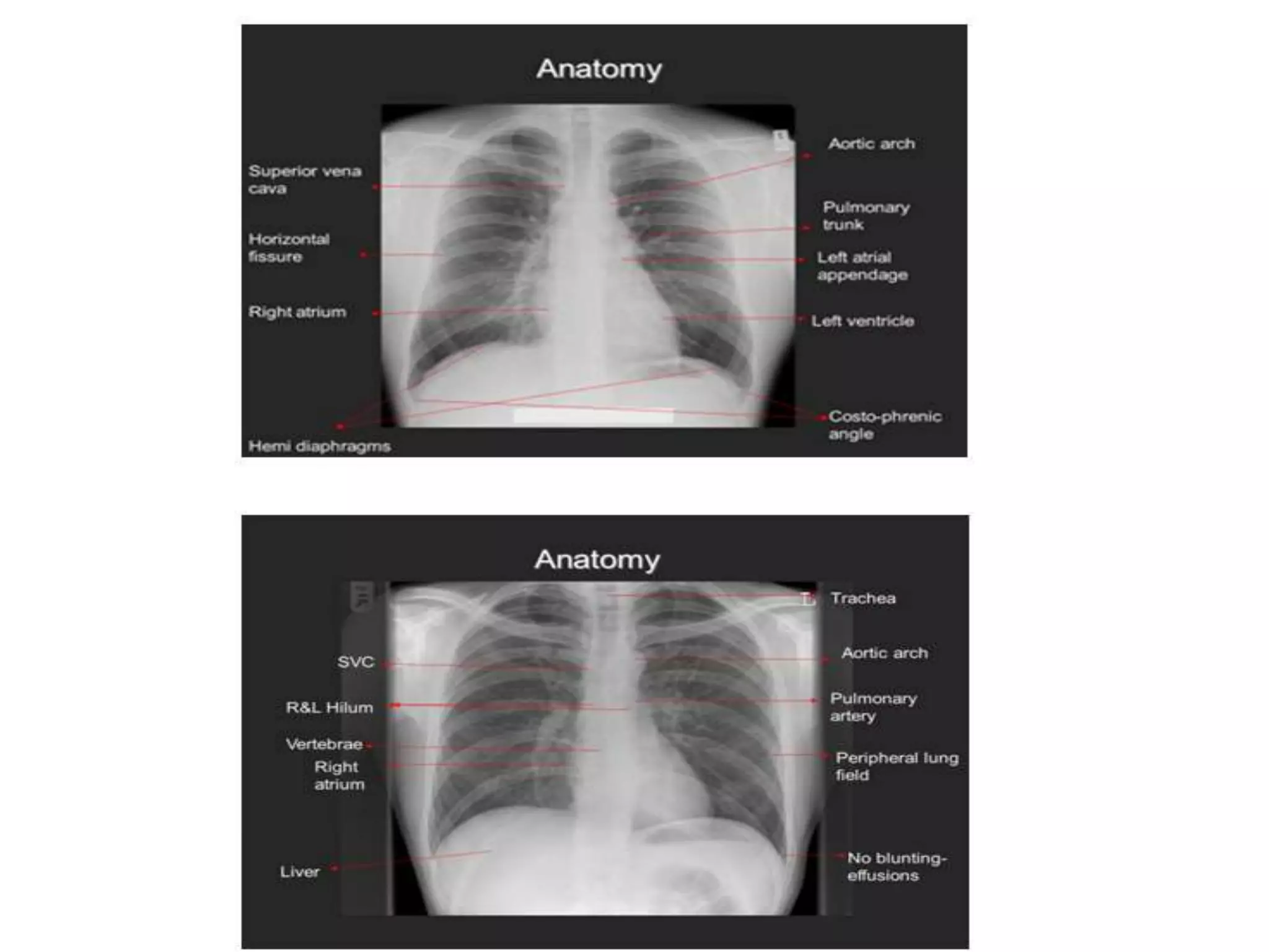 How to read a Chest X Ray film (Radiograph).pptx