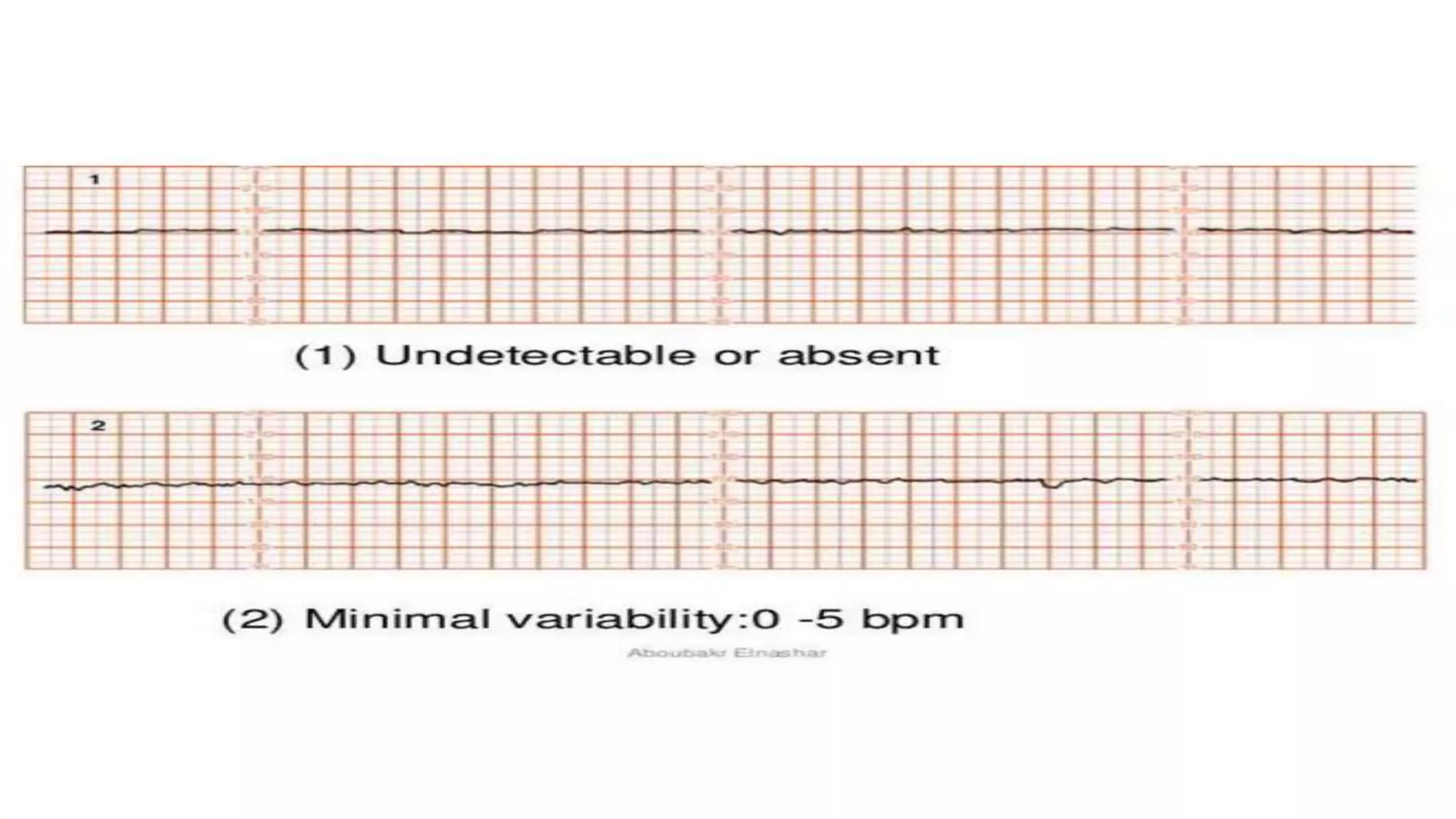 How to read a CTG دكتور صلاح رزق.pptx