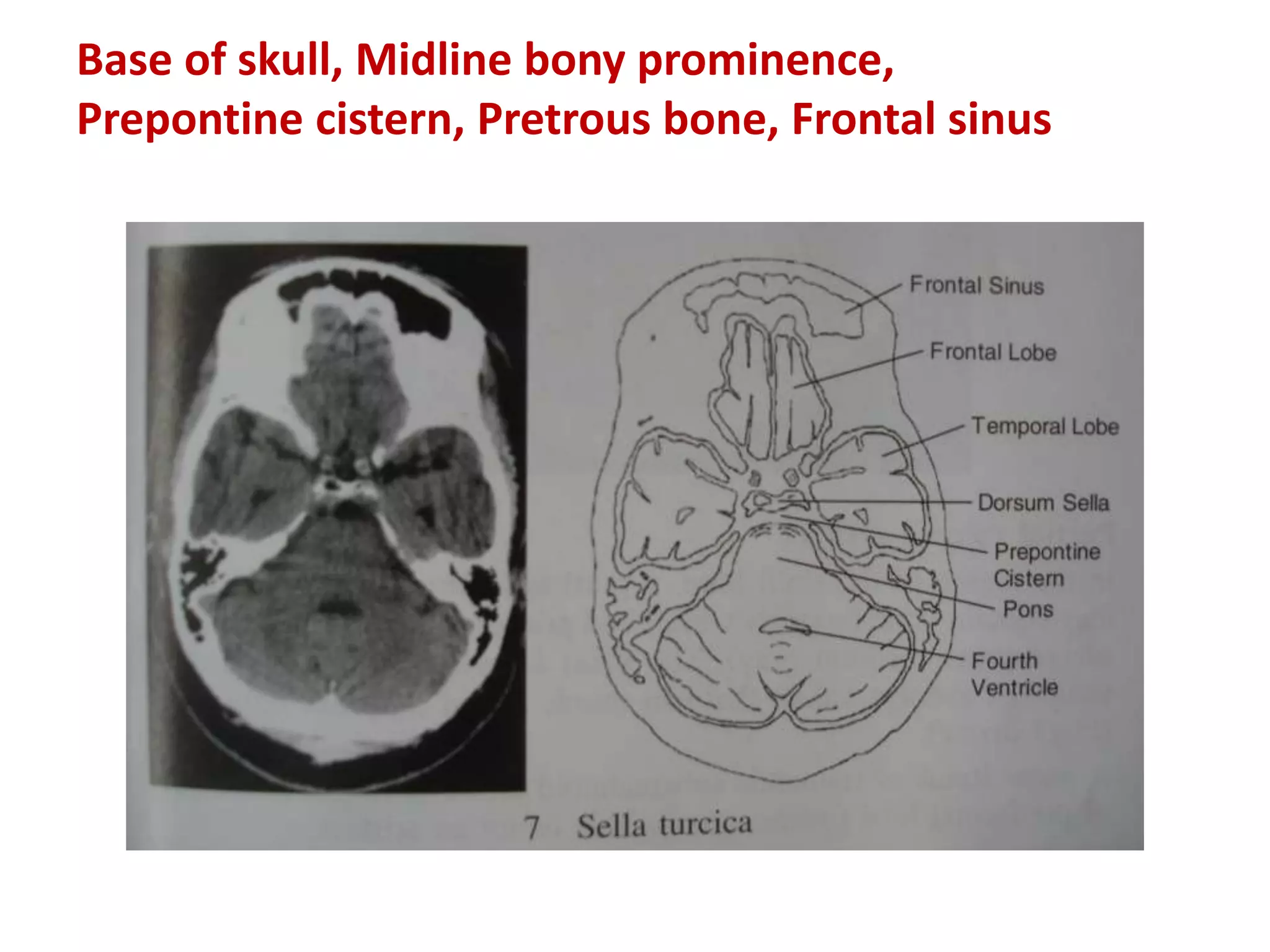 How To Read A Head CT Scan | PPTX