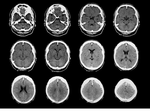 How To Read A Head CT Scan | PPTX