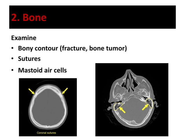 How To Read A Head CT Scan | PPTX