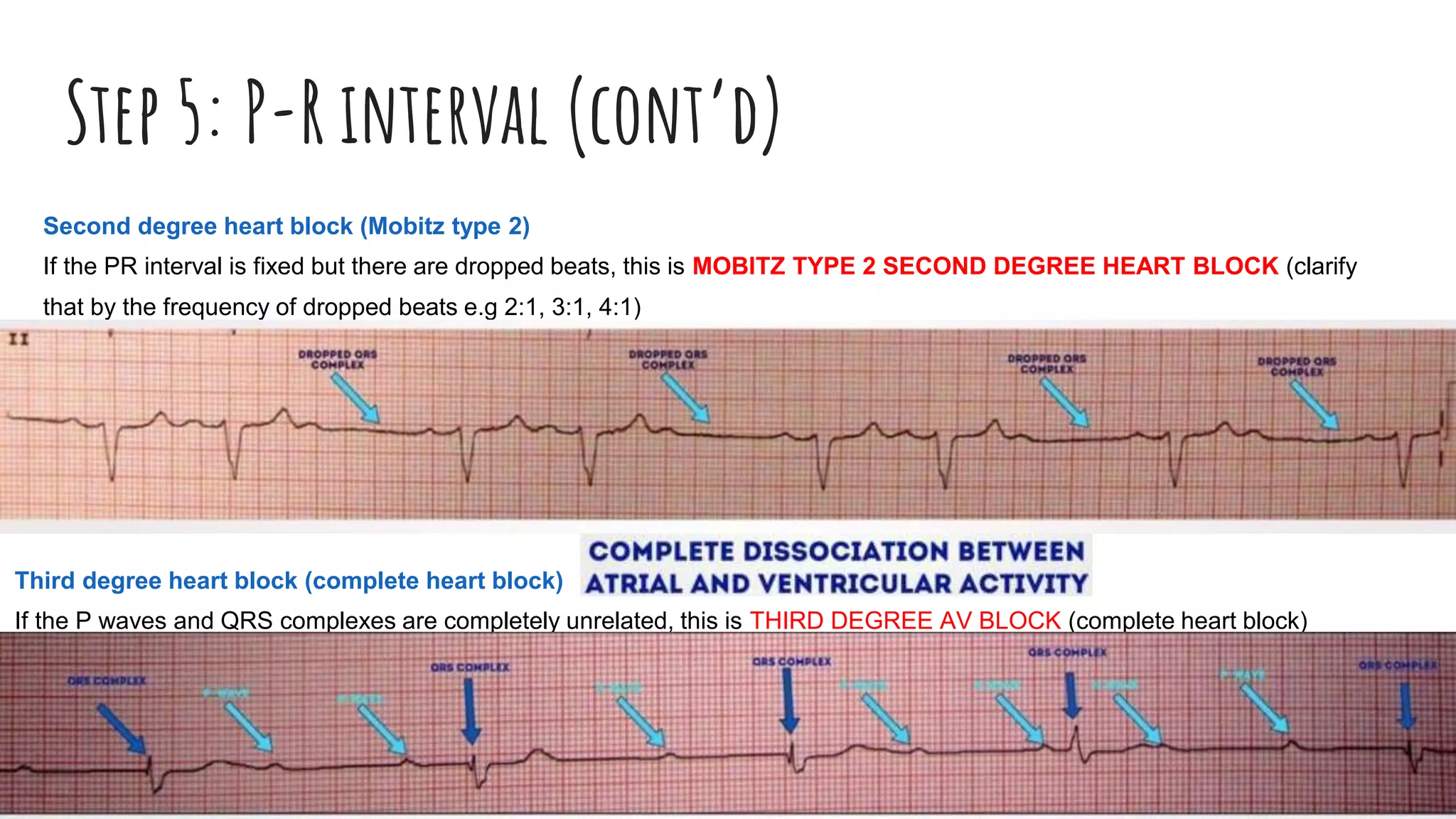 How to read an ecg | PPTX | Heart and Cardiovascular Diseases ...