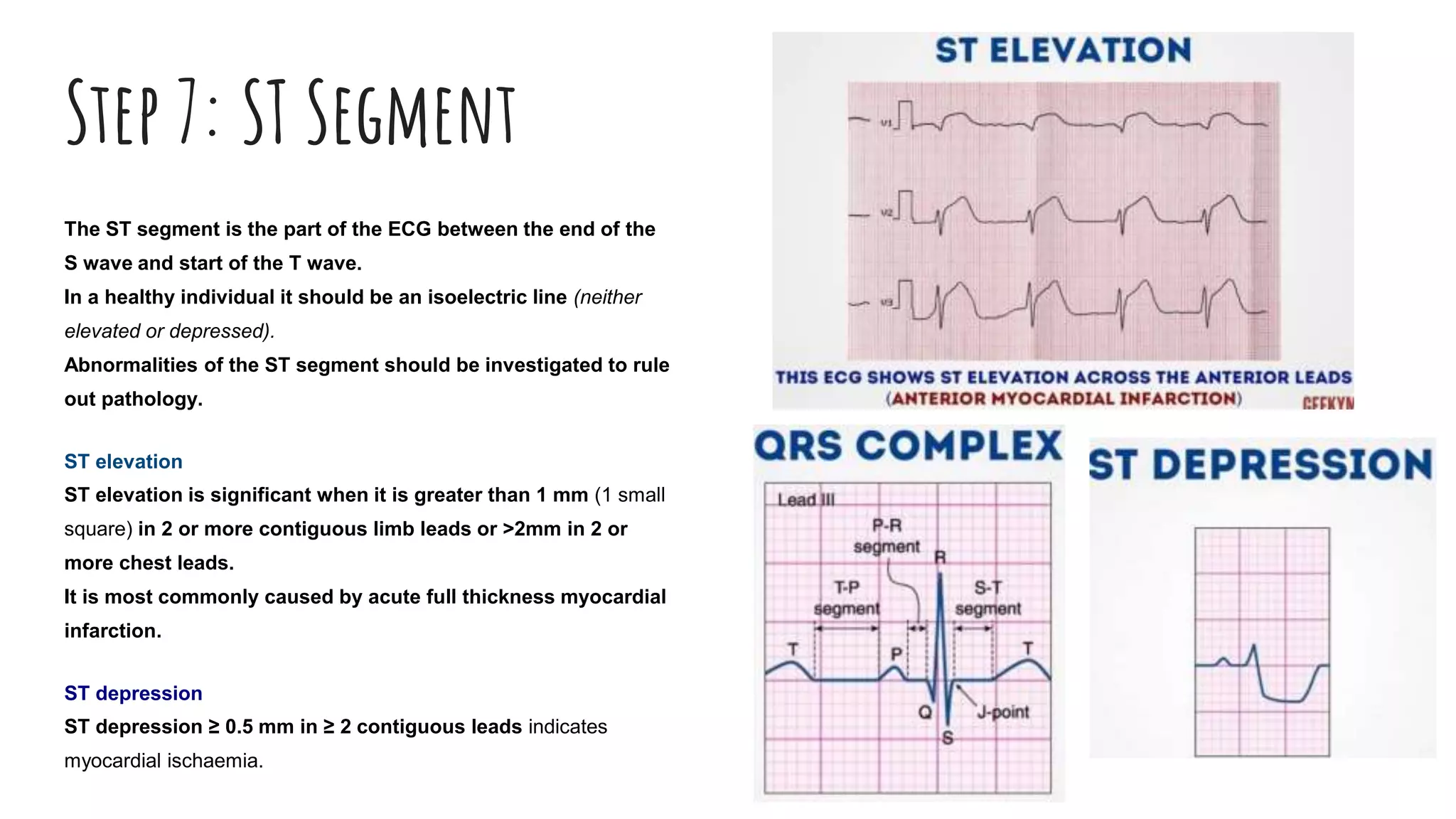 How to read an ecg | PPTX