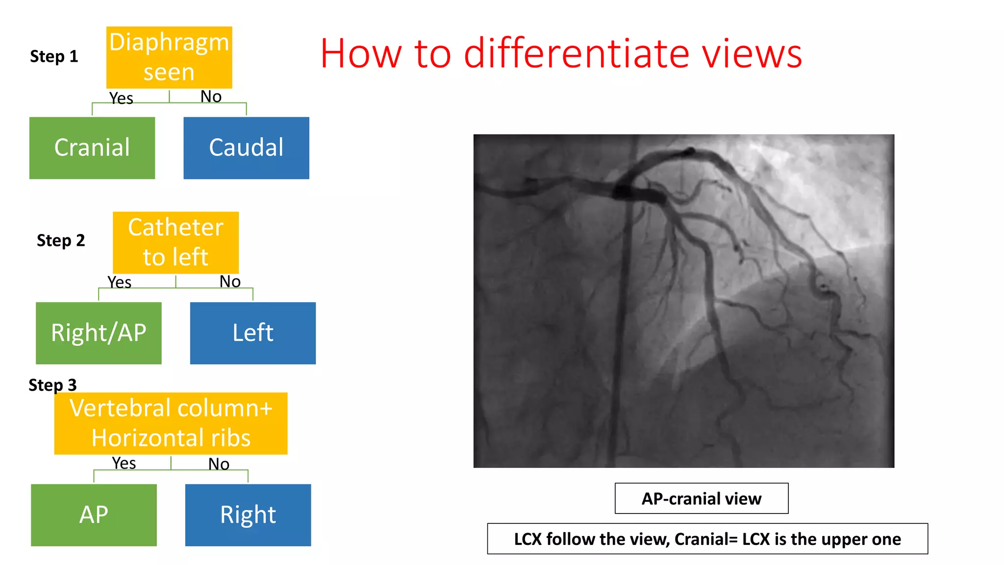 How to read coronary angiography | PPTX