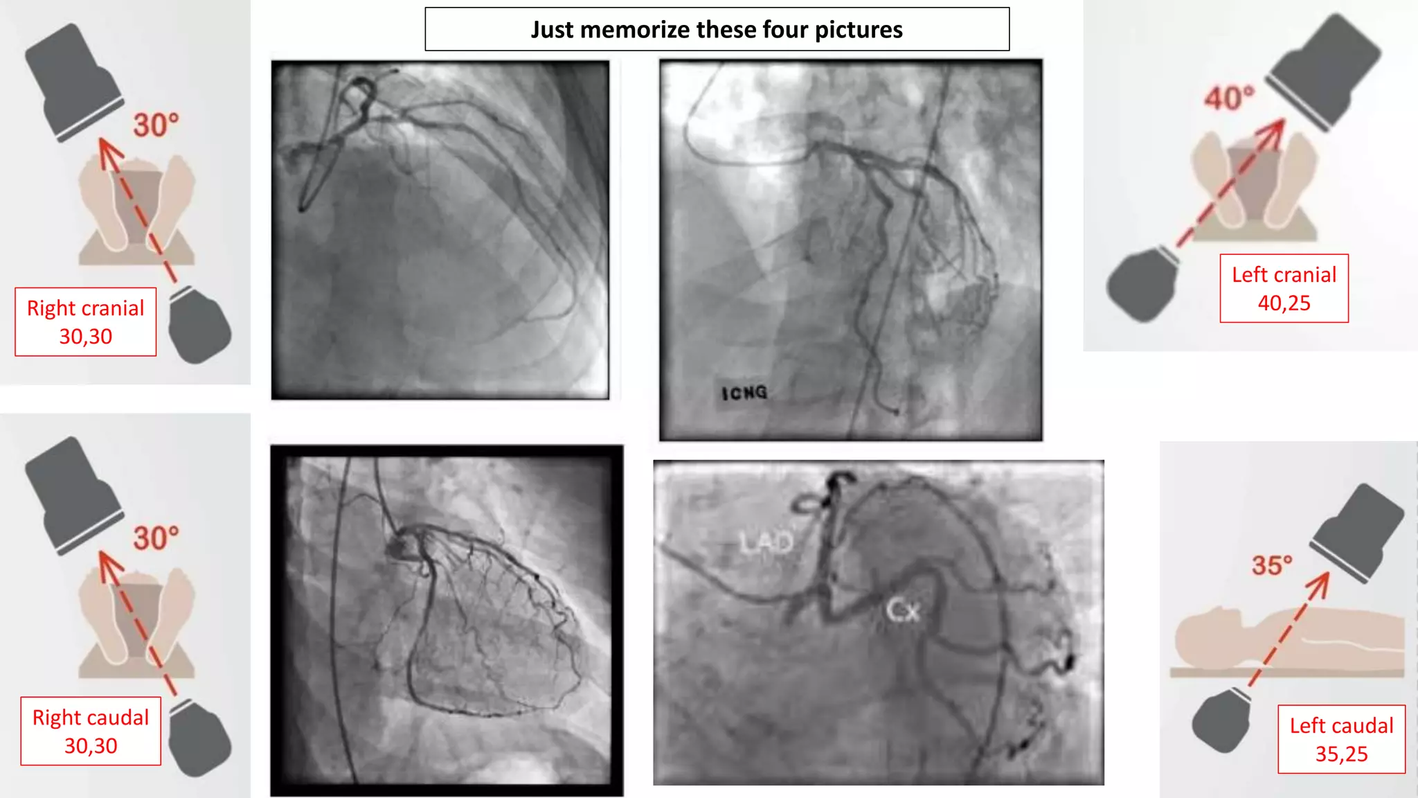 How to read coronary angiography | PPTX