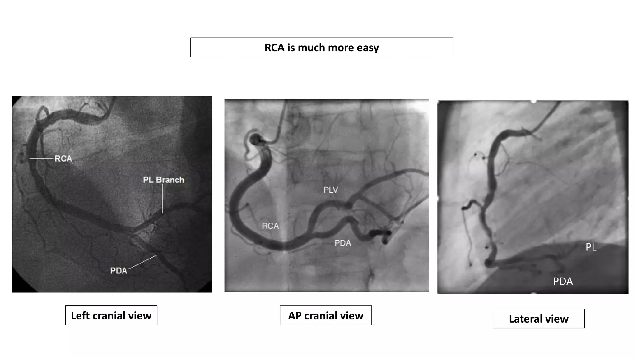 How to read coronary angiography | PPTX