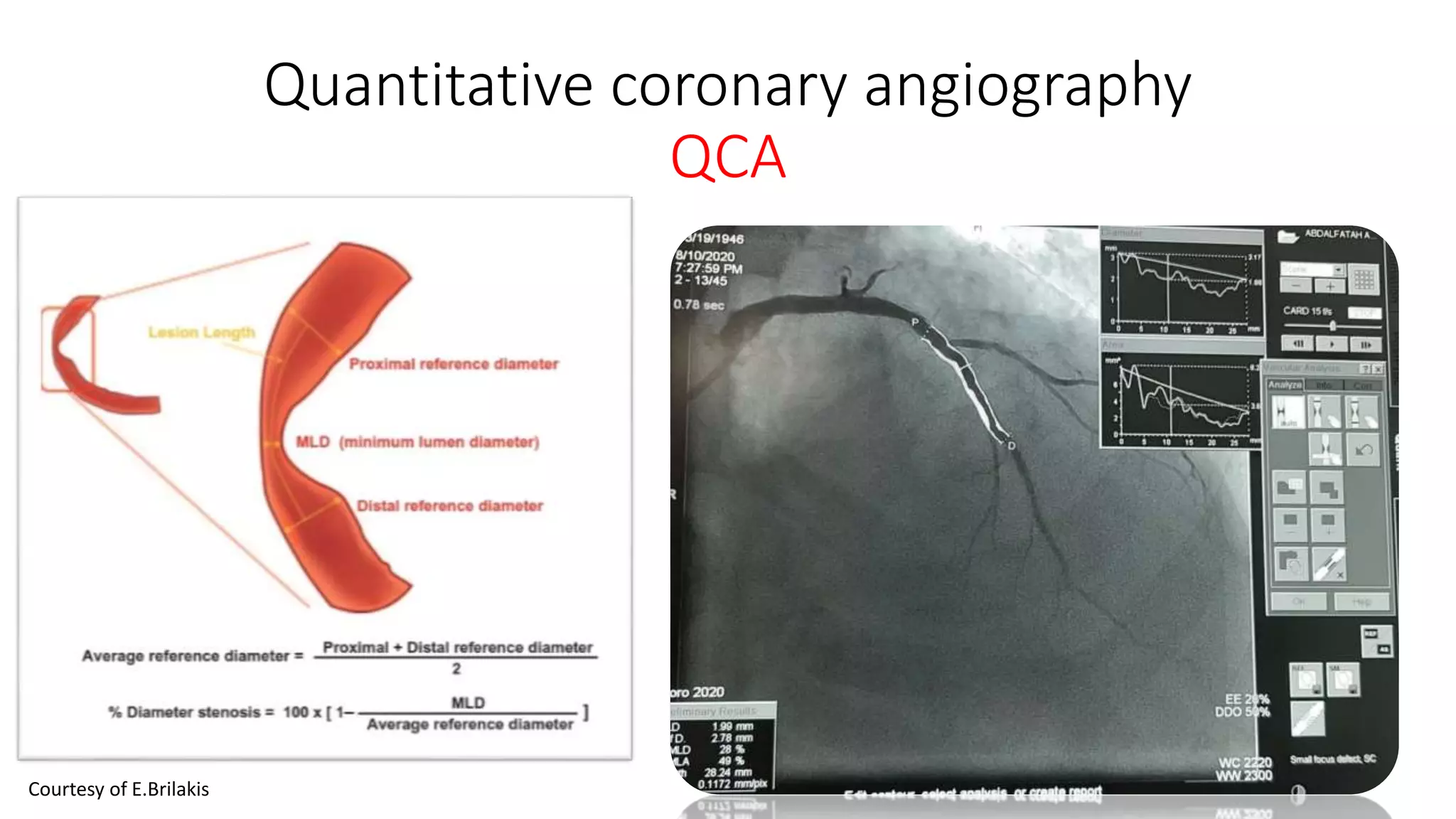 How to read coronary angiography | PPTX