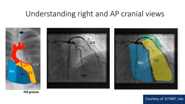 How to read coronary angiography | PPTX | Heart and Cardiovascular ...