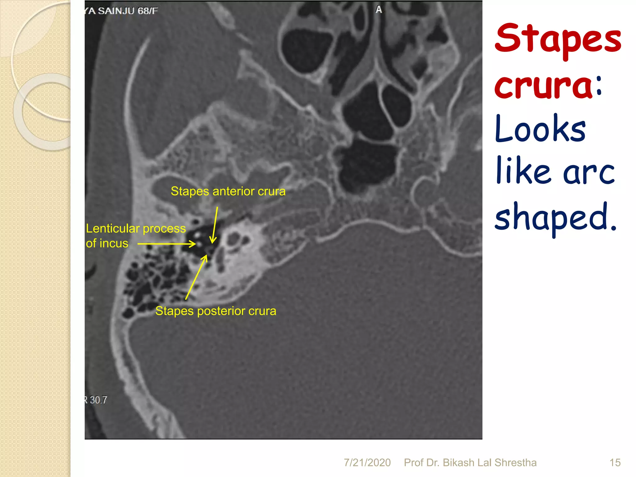 How to read ct scan temporal bone - A dhulikhel hospital, kathmandu ...