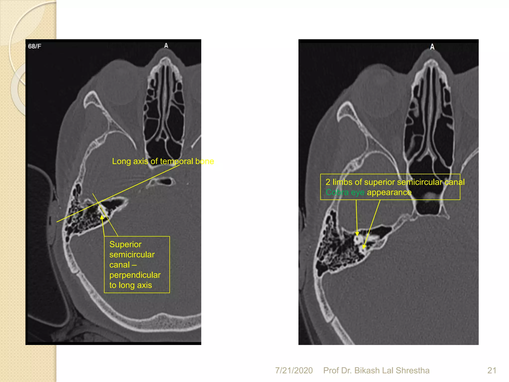 How to read ct scan temporal bone - A dhulikhel hospital, kathmandu ...