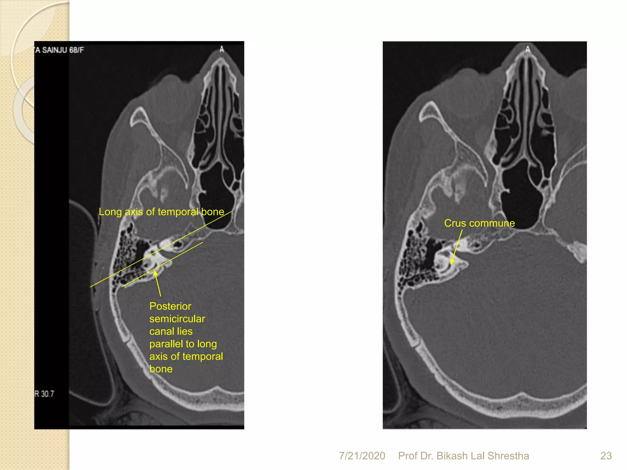How to read ct scan temporal bone - A dhulikhel hospital, kathmandu ...