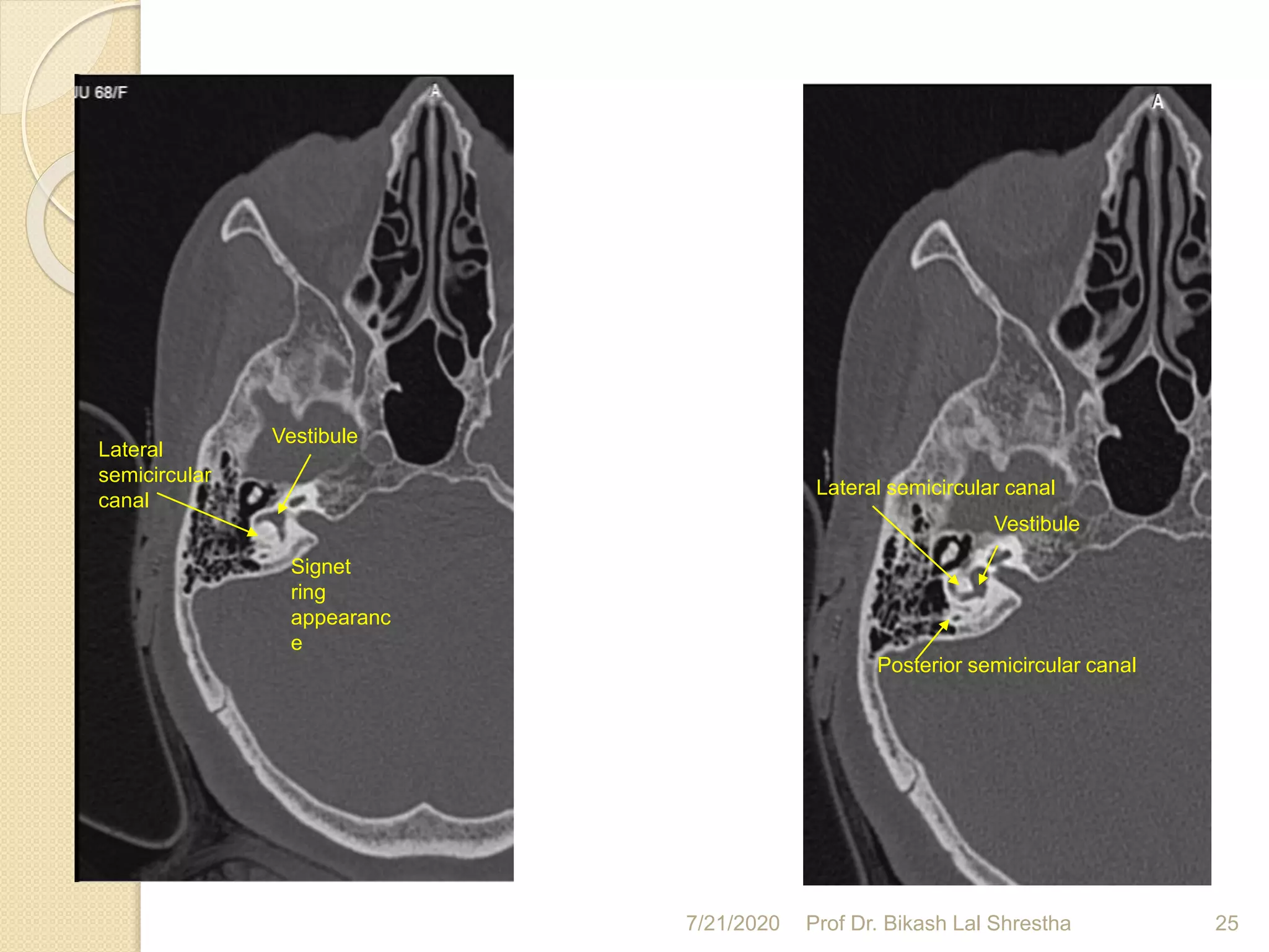 How to read ct scan temporal bone - A dhulikhel hospital, kathmandu ...