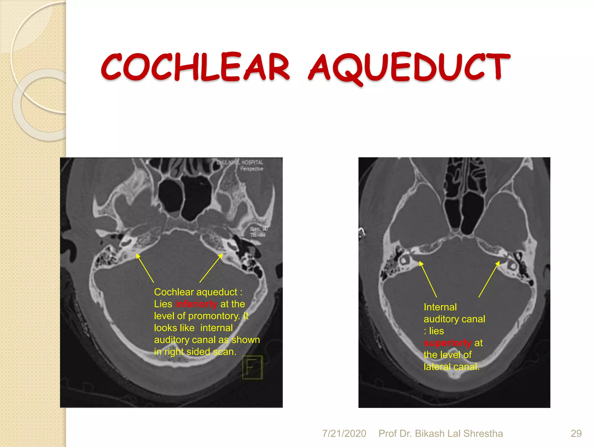 How to read ct scan temporal bone - A dhulikhel hospital, kathmandu ...