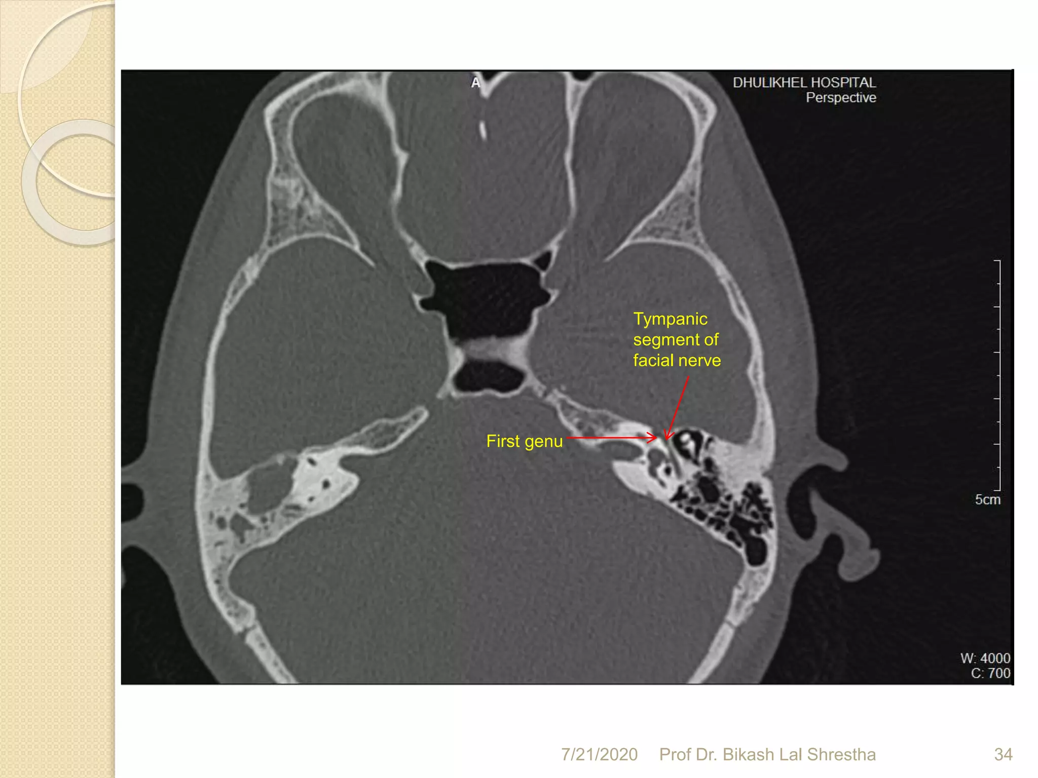 How to read ct scan temporal bone - A dhulikhel hospital, kathmandu ...