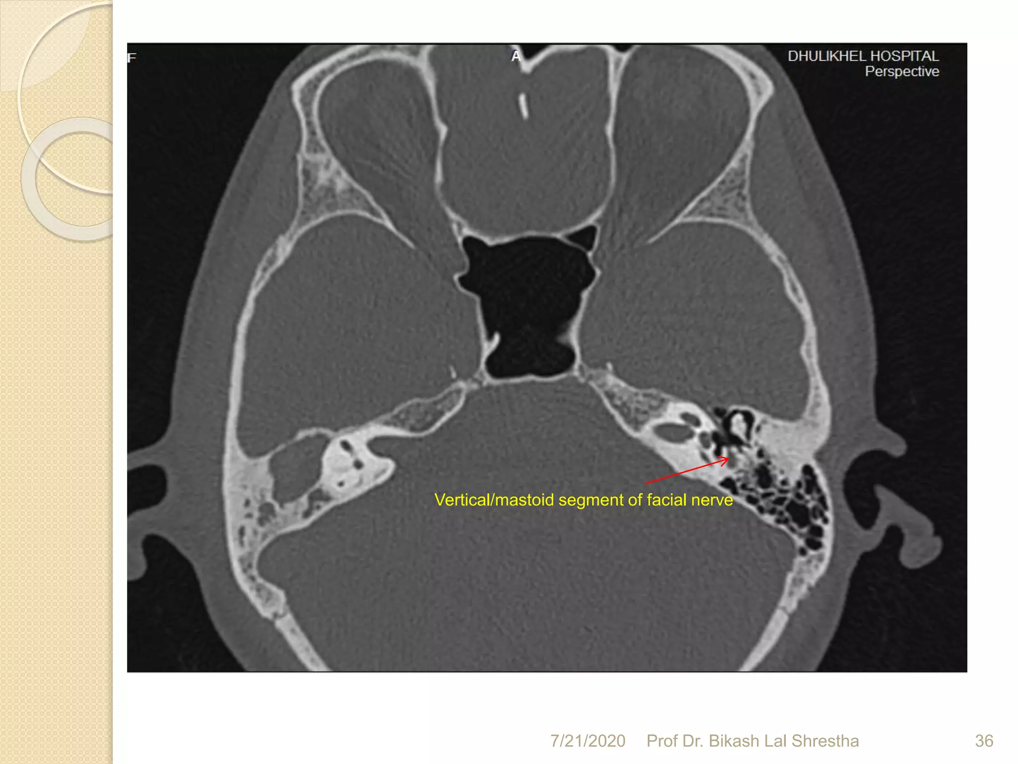How to read ct scan temporal bone - A dhulikhel hospital, kathmandu ...