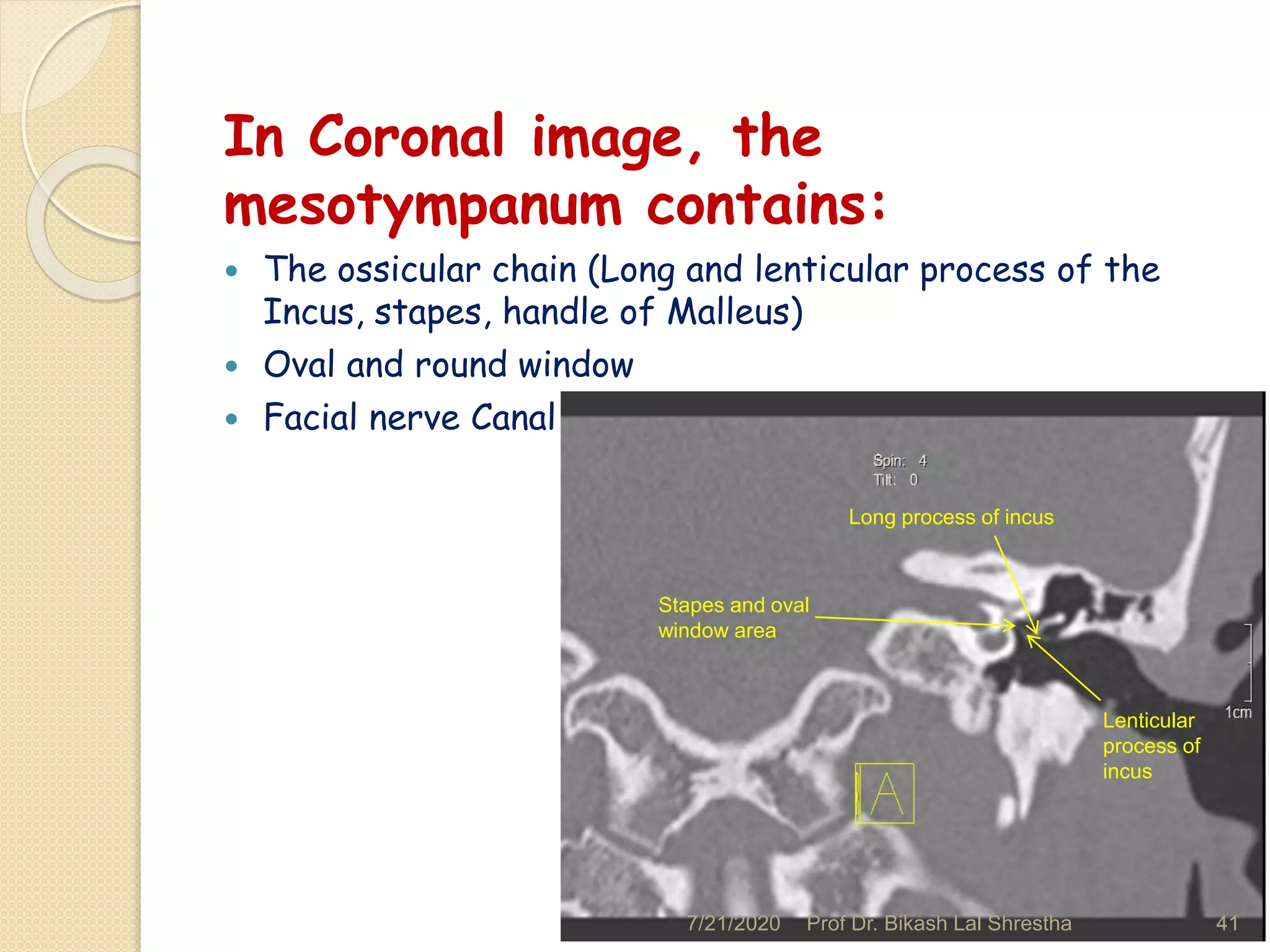 How to read ct scan temporal bone - A dhulikhel hospital, kathmandu ...