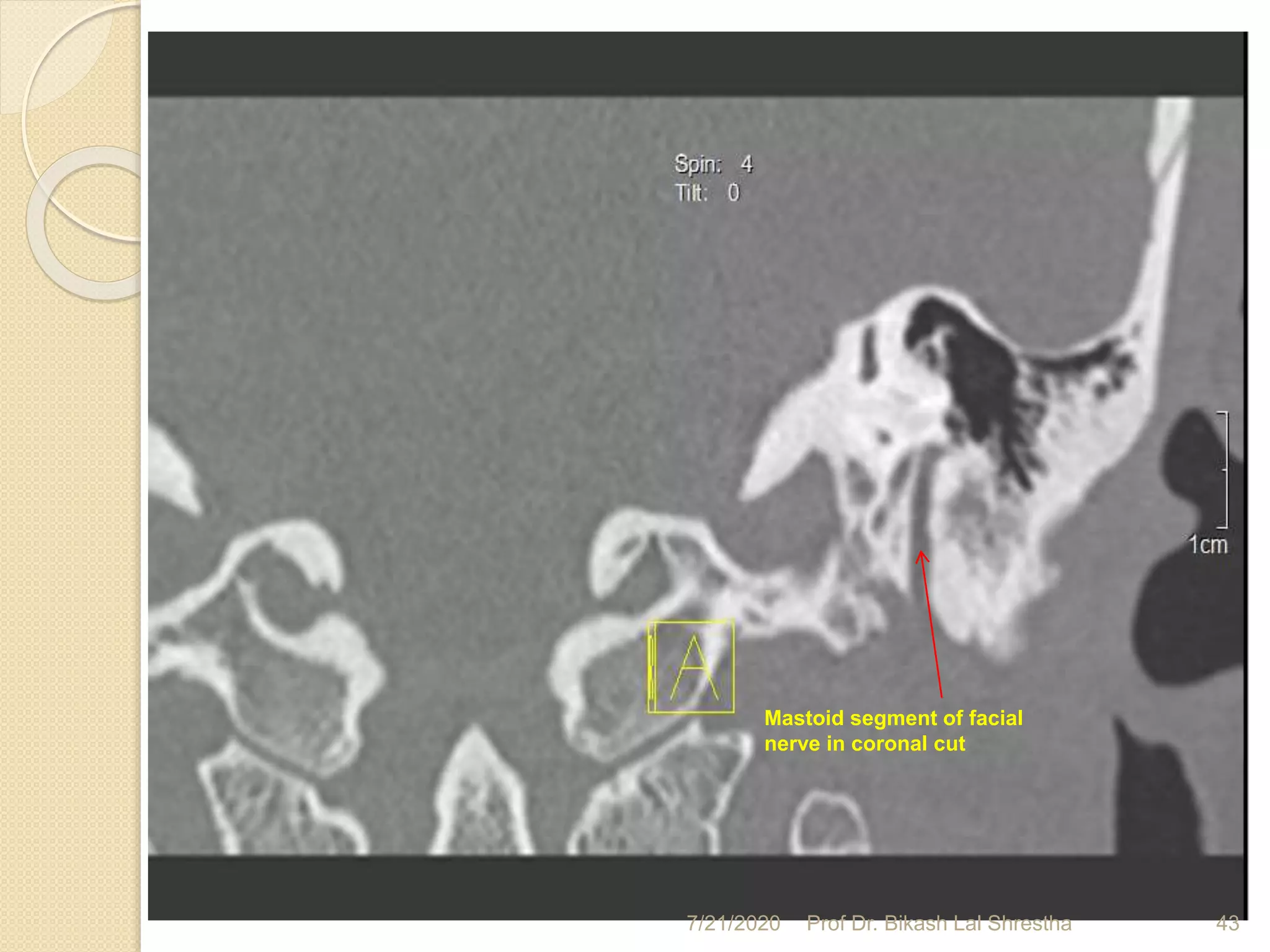 How to read ct scan temporal bone - A dhulikhel hospital, kathmandu ...