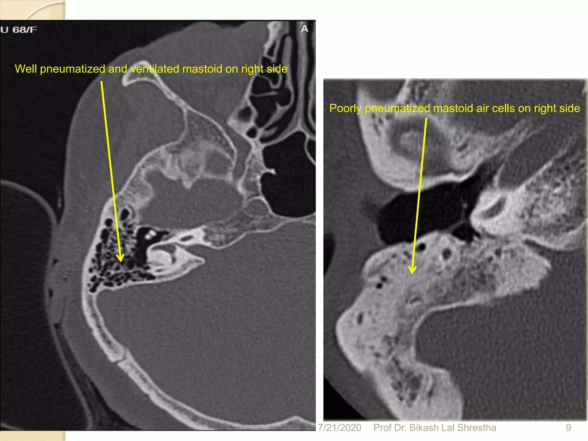 How to read ct scan temporal bone - A dhulikhel hospital, kathmandu ...