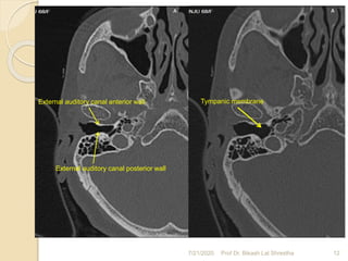 How to read ct scan temporal bone - A dhulikhel hospital, kathmandu ...