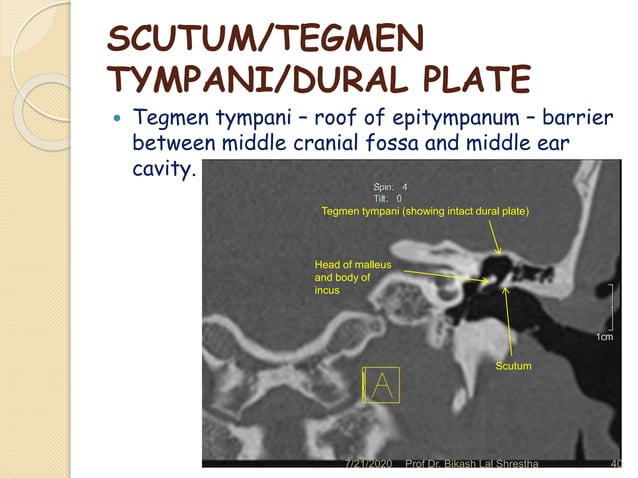 How to read ct scan temporal bone - A dhulikhel hospital, kathmandu ...