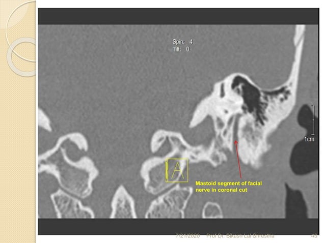 How to read ct scan temporal bone - A dhulikhel hospital, kathmandu ...