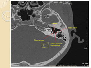 How to read ct scan temporal bone - A dhulikhel hospital, kathmandu ...