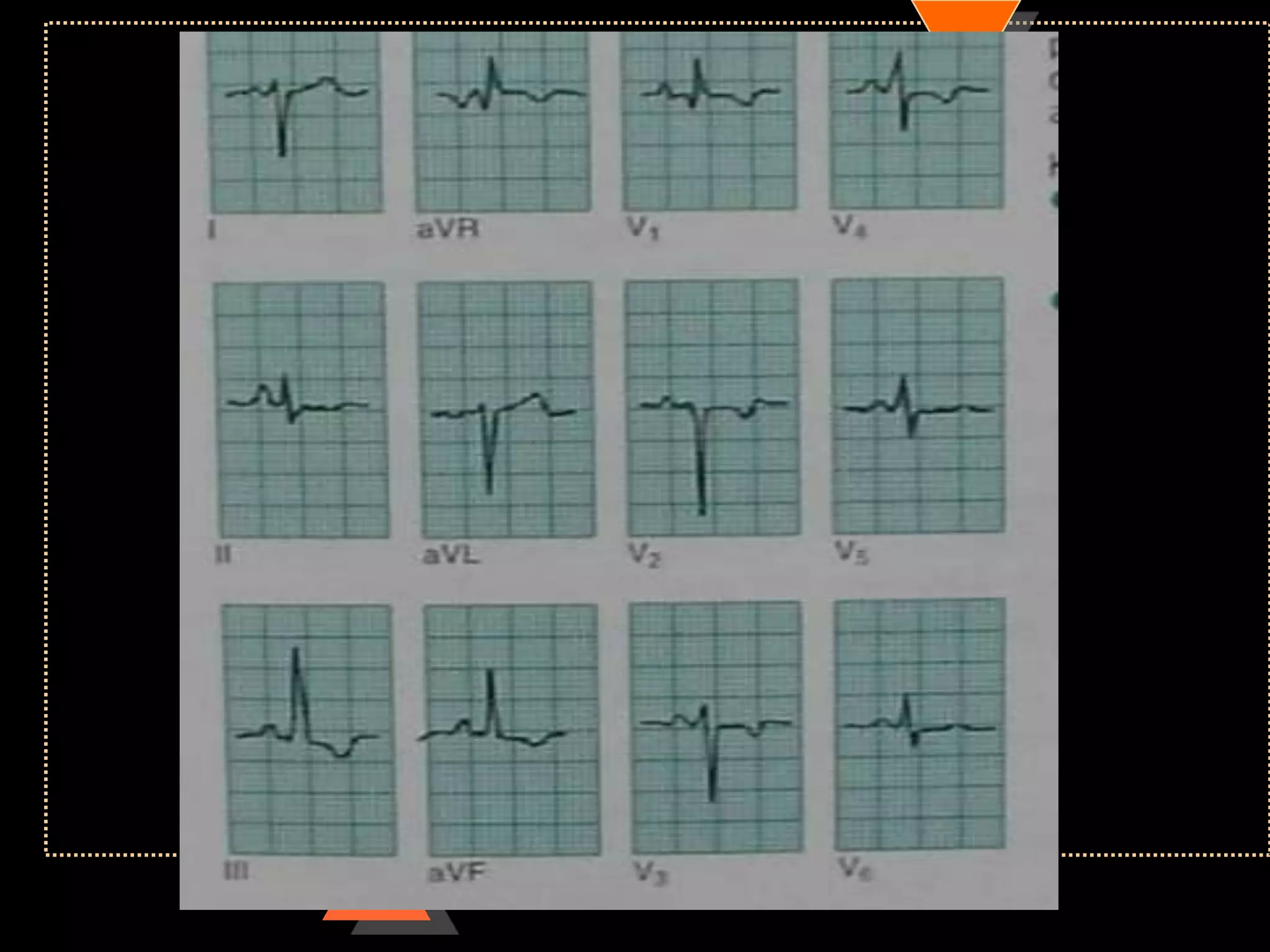 How to read ECG | PPSX