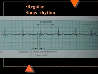 Normal Ecg Reading