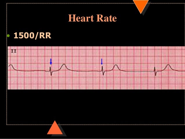 How to read ECG