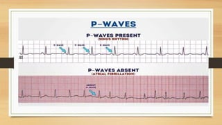 How to read ecg (basic ecg findings) | PPTX