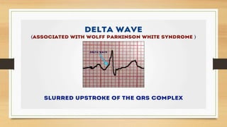 How to read ecg (basic ecg findings) | PPTX