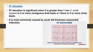 How to read ecg (basic ecg findings) | PPTX