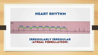 How to read ecg (basic ecg findings) | PPTX