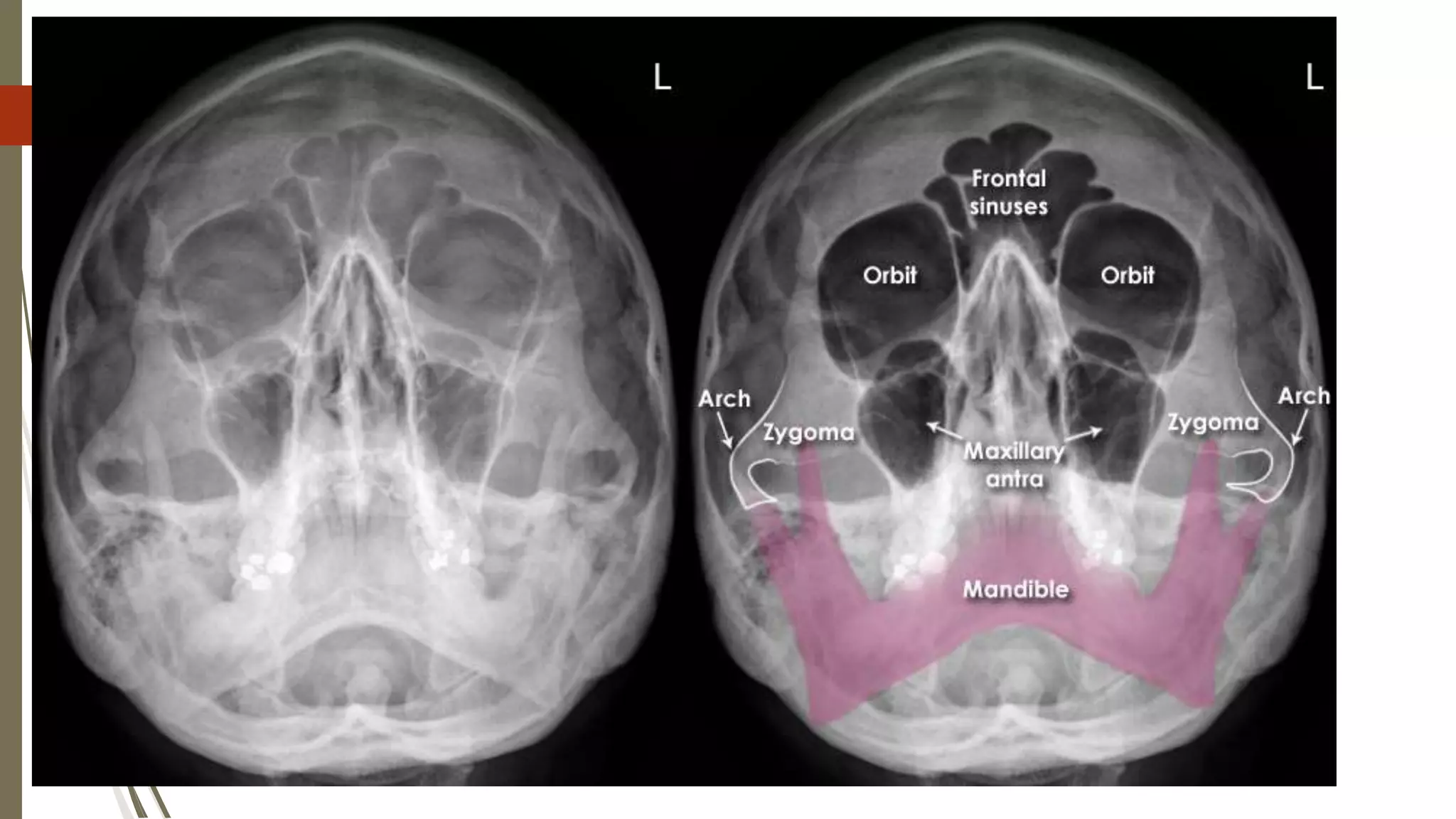 How To Read Facial Bone X-Rays By Peter Andre Soltau -Jan2015 | PPTX