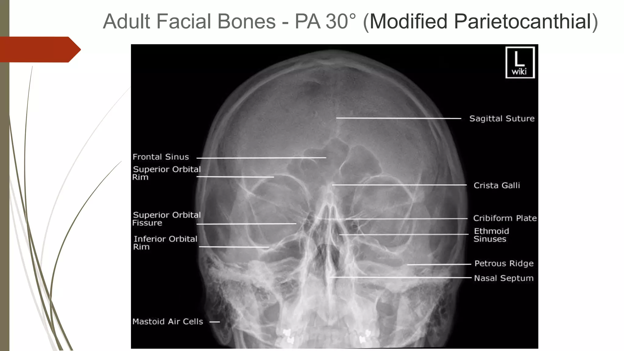 How To Read Facial Bone X-Rays By Peter Andre Soltau -Jan2015 | PPTX