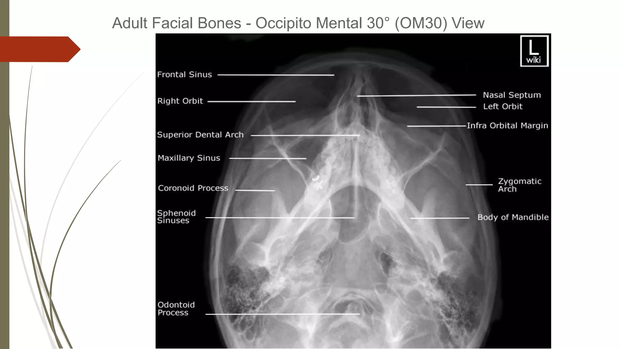How To Read Facial Bone X-Rays By Peter Andre Soltau -Jan2015 | PPTX