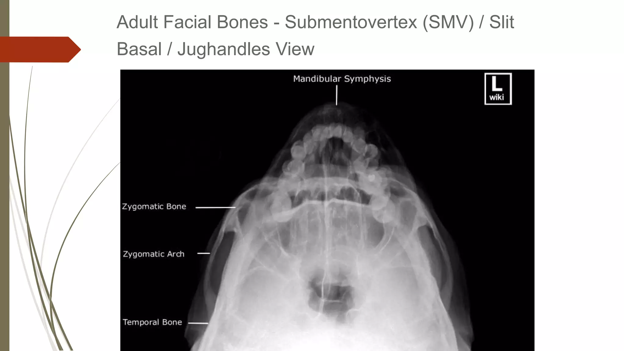 How To Read Facial Bone X-Rays By Peter Andre Soltau -Jan2015 | PPTX