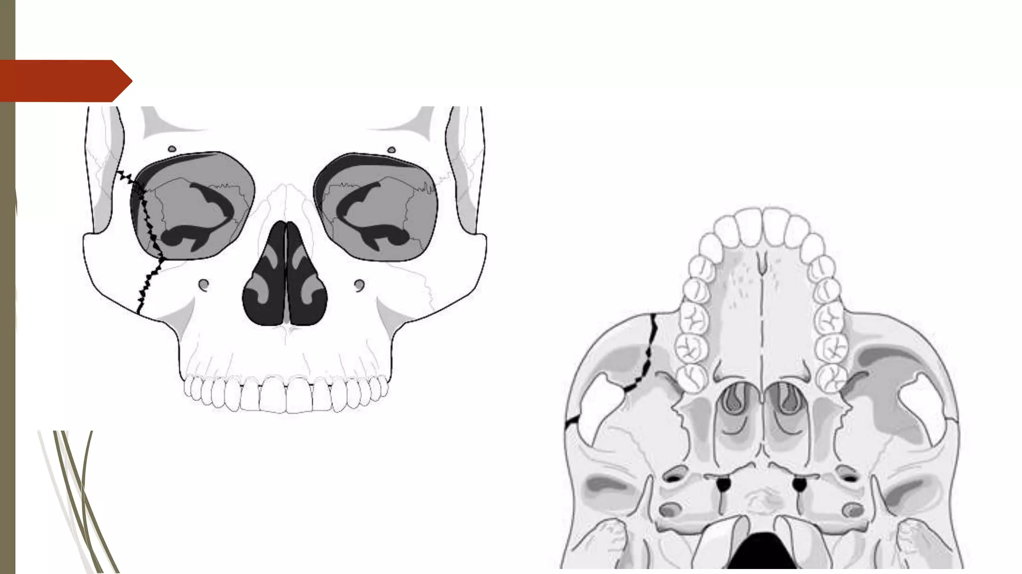 How To Read Facial Bone X-Rays By Peter Andre Soltau -Jan2015 | PPTX
