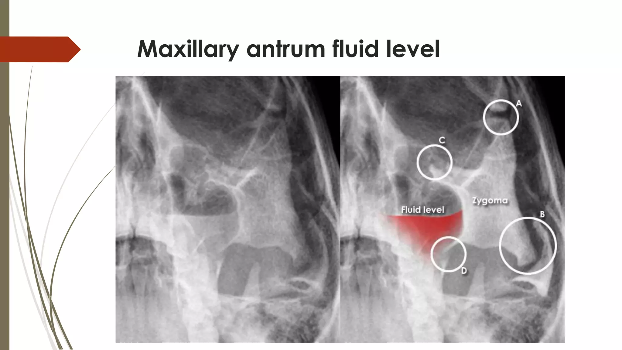How To Read Facial Bone X-Rays By Peter Andre Soltau -Jan2015 | PPTX