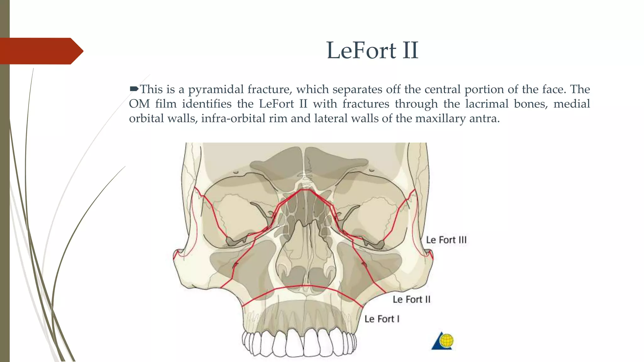How To Read Facial Bone X-Rays By Peter Andre Soltau -Jan2015 | PPTX