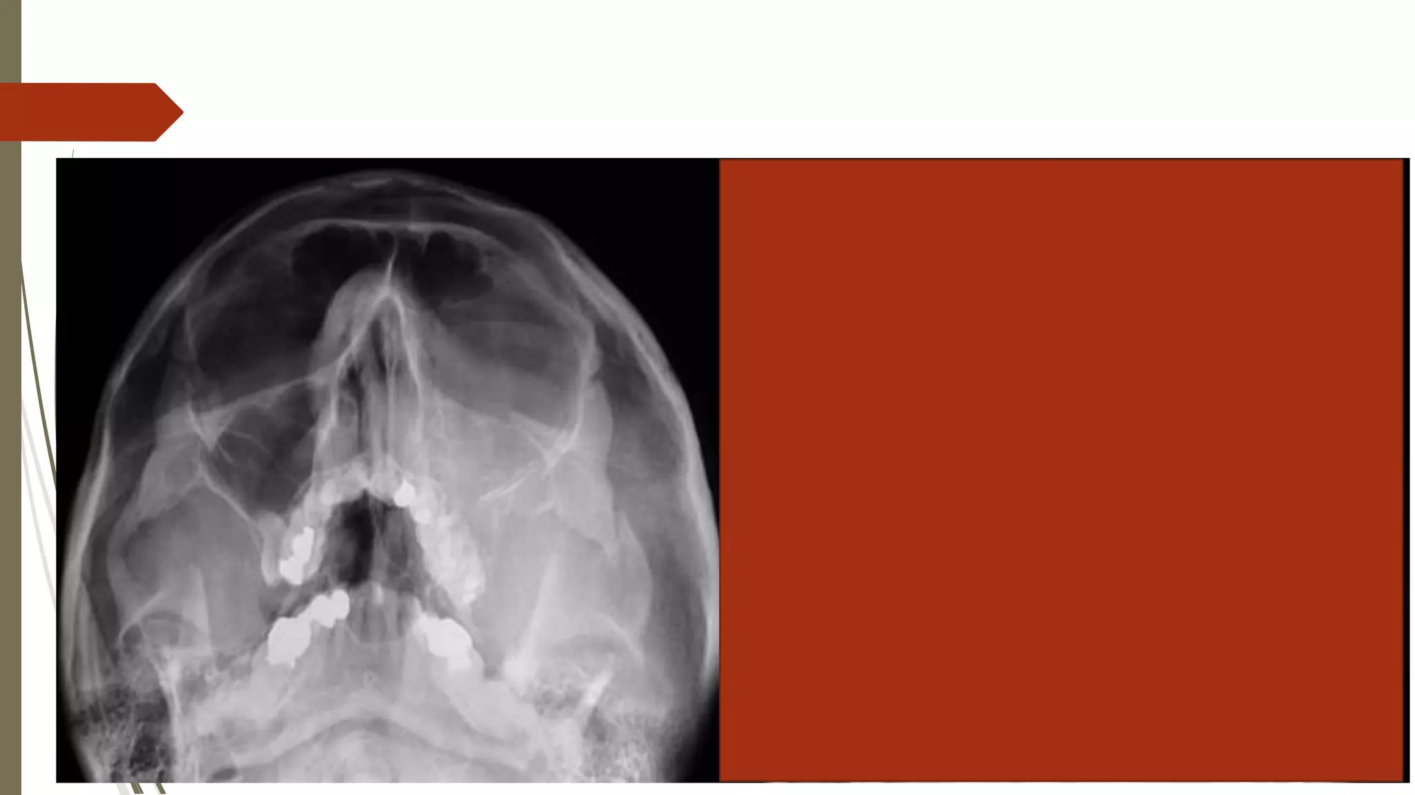How To Read Facial Bone X-Rays By Peter Andre Soltau -Jan2015 | PPTX