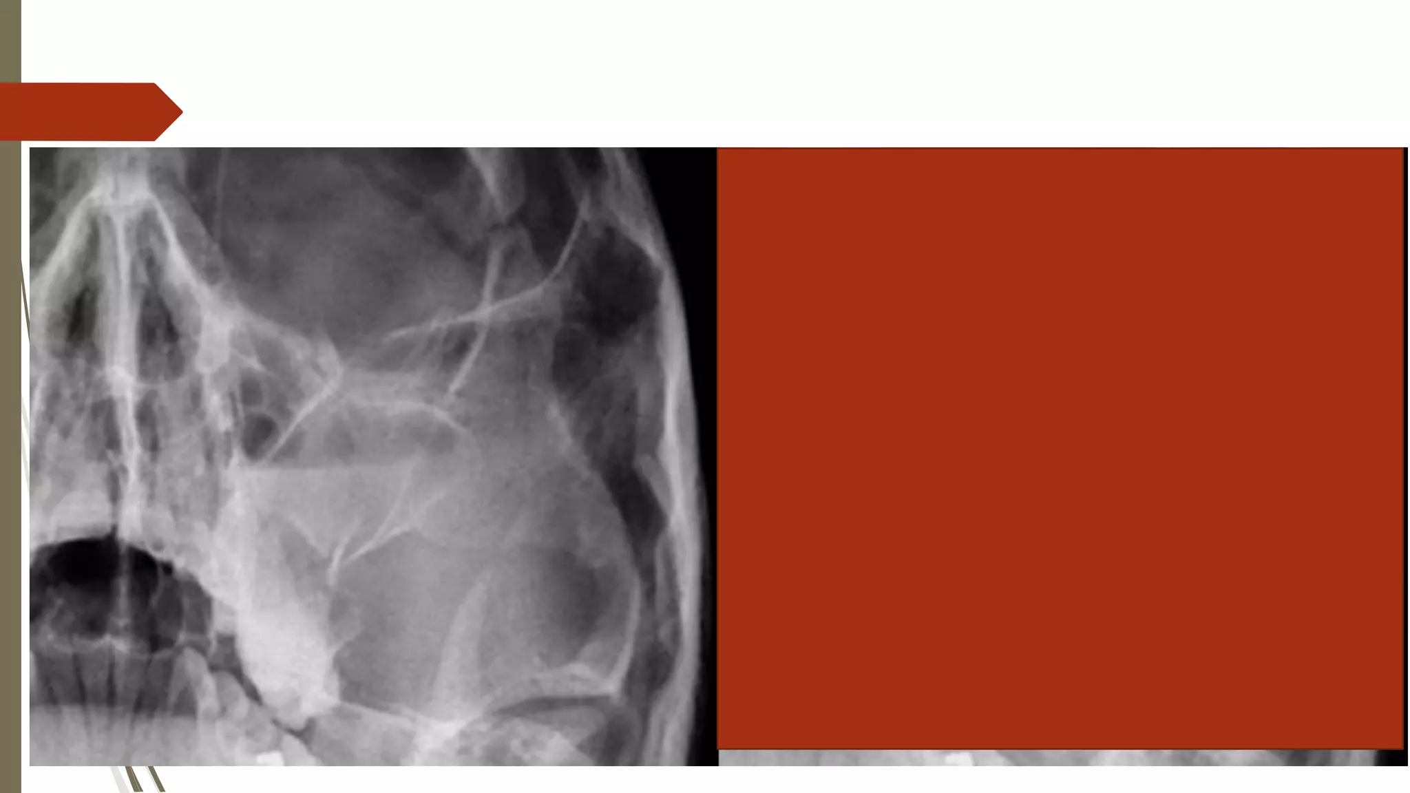 How To Read Facial Bone X-Rays By Peter Andre Soltau -Jan2015 | PPTX