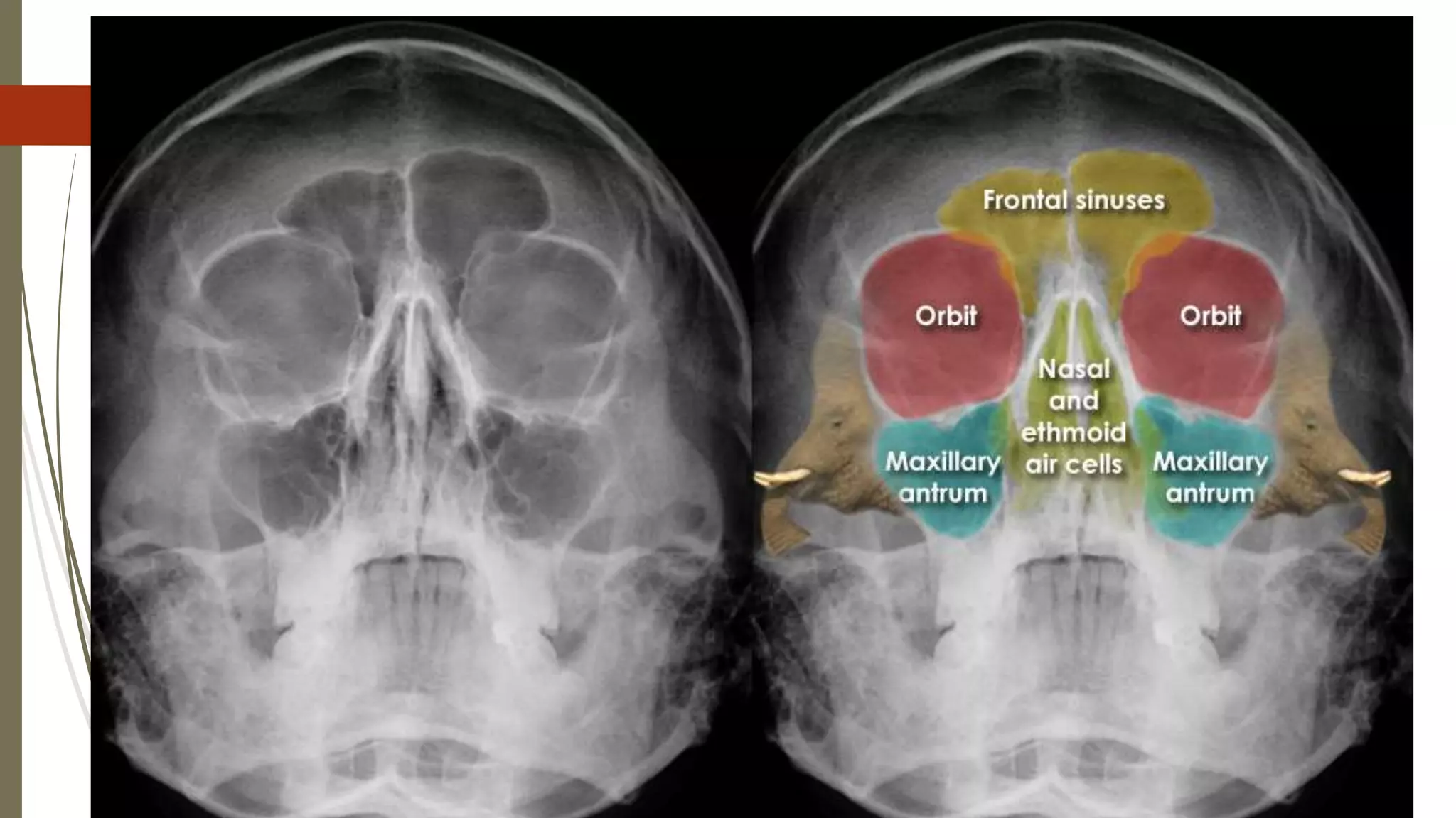 How To Read Facial Bone X-Rays By Peter Andre Soltau -Jan2015 | PPTX