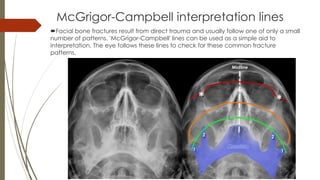 How To Read Facial Bone X-Rays By Peter Andre Soltau -Jan2015 | PPT