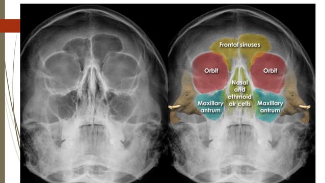 How To Read Facial Bone X-Rays By Peter Andre Soltau -Jan2015