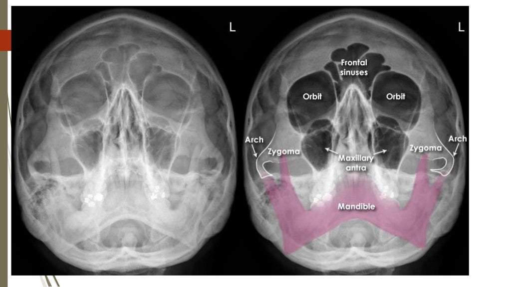 How To Read Facial Bone X-Rays By Peter Andre Soltau -Jan2015